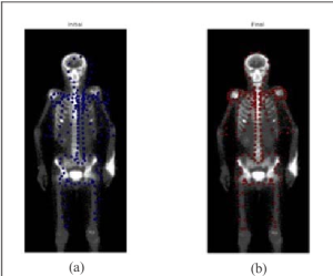 Bone Scan Image Segmentation based on Active Shape Model for Cancer ...